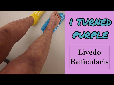 Mild Livedo Reticularis