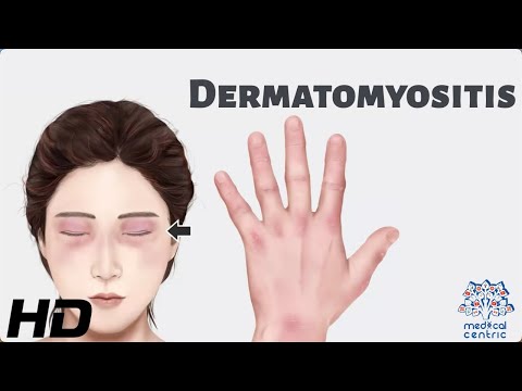Dermatomyositis: Everything You Need To Know