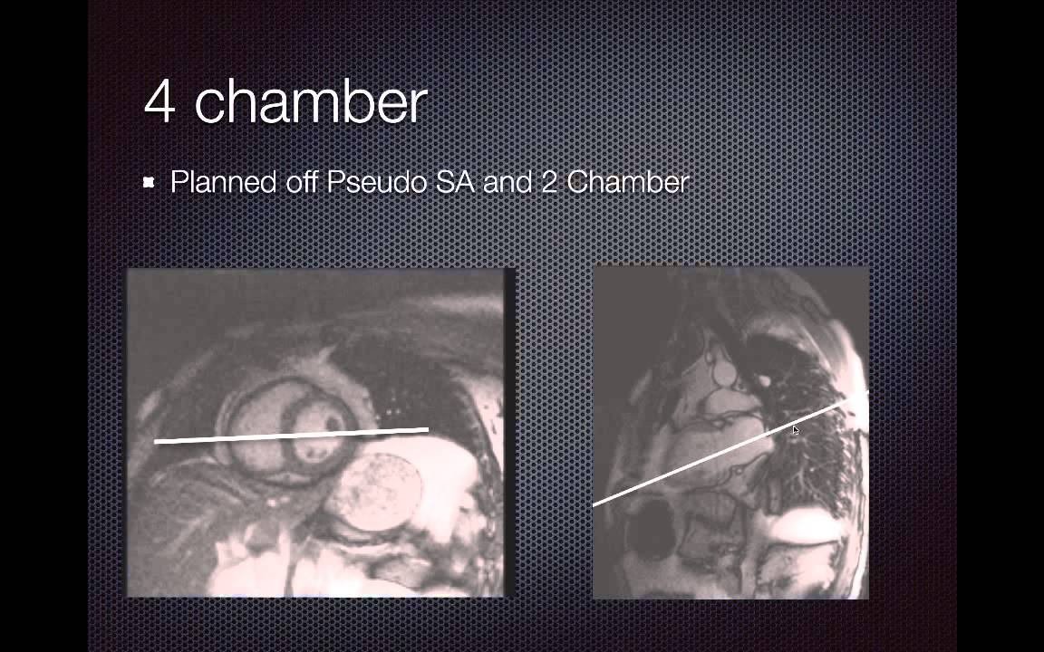 MRI Imaging Planes