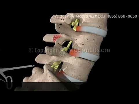 Lumbar Fusion 2
