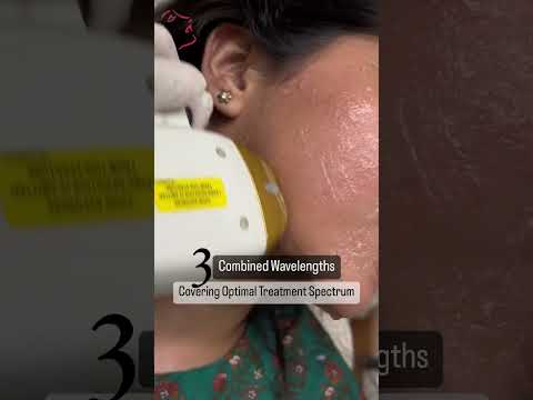 Soprano ICE Platinum Laser Hair Removal