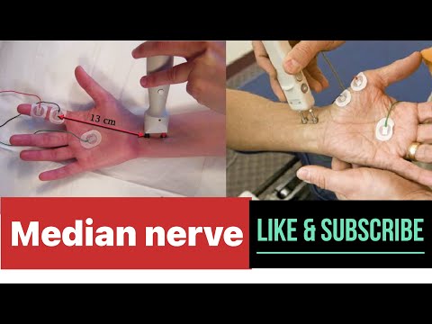MEDIAN NERVE- NERVE CONDUCTION STUDY | NCS | NCV #emg #ncs #ncv #neuroscience