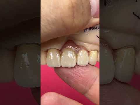 Signature Ceramic Bridge with Pink Esthetic