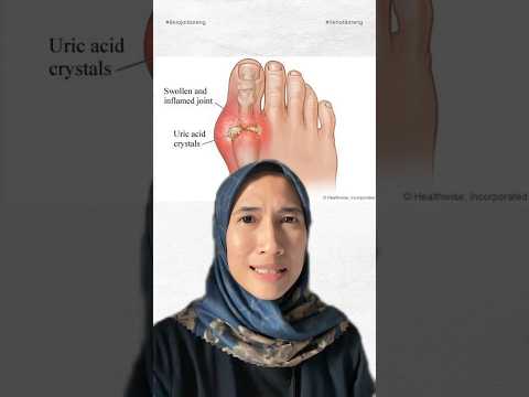 Apa Itu ASAM URAT?