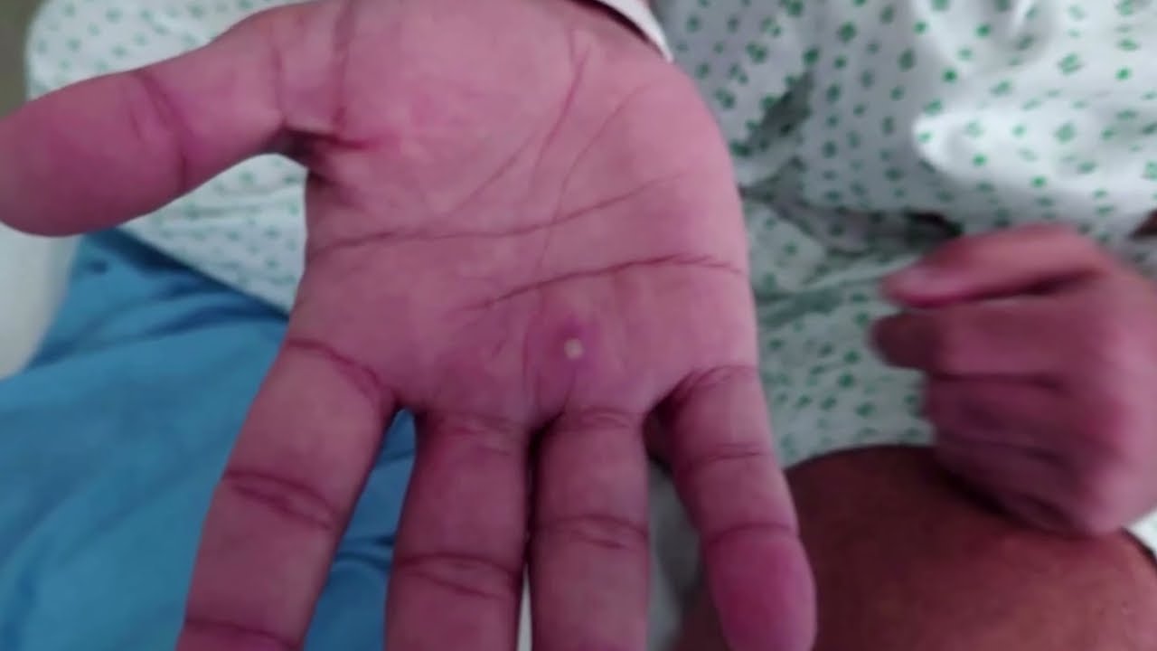 U.S. declares monkeypox a public health emergency
