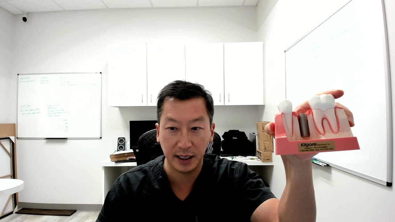 Debunking Myths: The Real Facts About Dental Implants You Need to Know