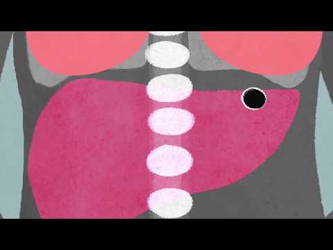 What is secondary breast cancer?