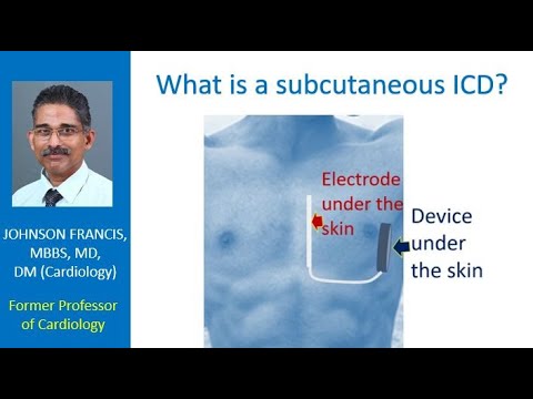 What is a subcutaneous ICD?