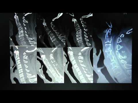 Occipital Cervical Posterior Laminectomy and Fusion for C2 Pannus and stenosis