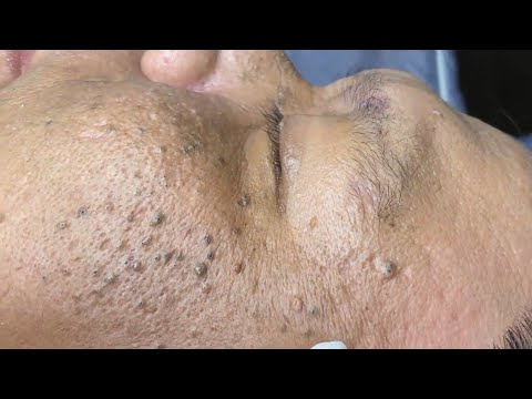 Big Cystic Acne Blackheads Extraction Blackheads & Milia, Whiteheads Removal pimple popping