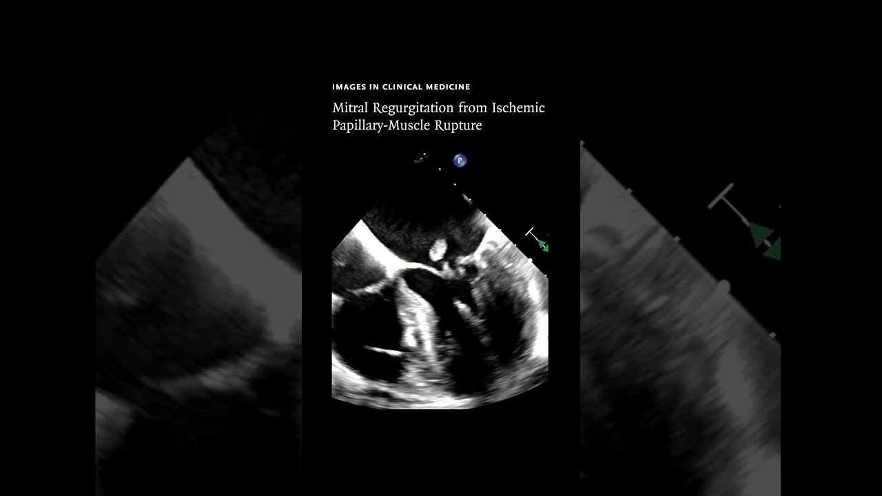 Images in Clinical Medicine: Mitral Regurgitation from Ischemic Papillary-Muscle Rupture