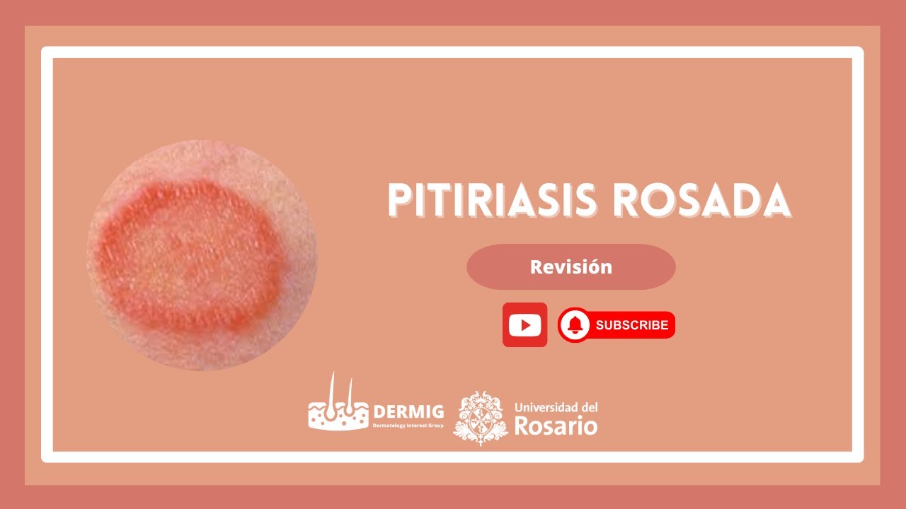 PITYRIASIS ROSEA REVIEW