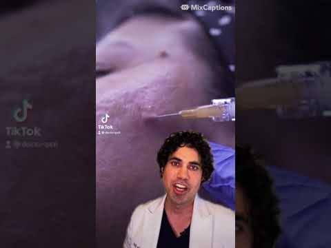 Filler For Acne Scars by Dr. Nadir Qazi