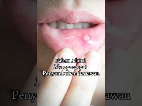 Tips Menyembuhkan Sariawan dengan cepat #obat #alami #sariawan
