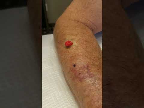 Lipoma Removal