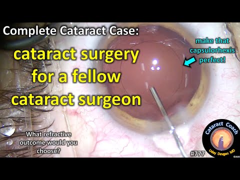 cataract surgeon on the eyes of a fellow cataract surgeon