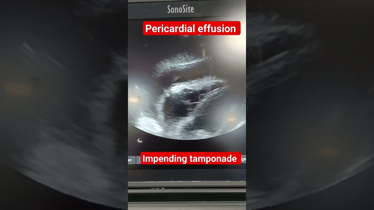 pericardial effusion resulting in impending tamponade #medicine #emergency #meded #education #aiims