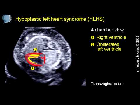Hypoplastic left heart syndrome (HLHS) at 12 weeks of pregnancy