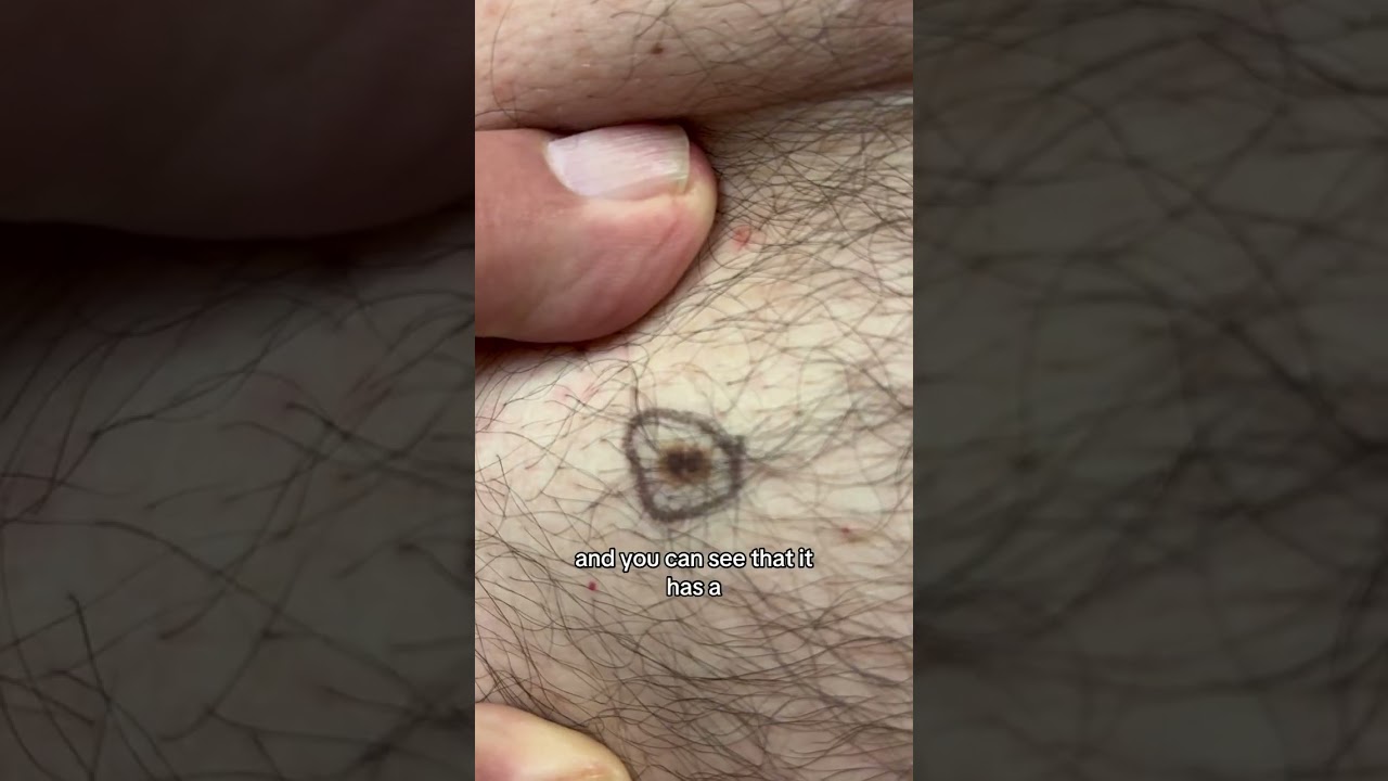 Dermatologist with 50 years experience shows mole to remove and check for cancer👨🏻‍⚕️