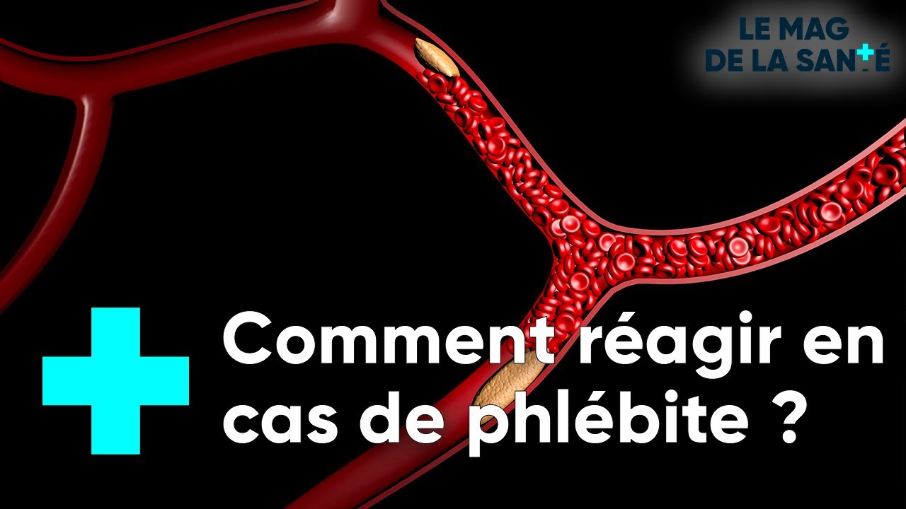 Phlebitis: Beware of Embolism! - Health Magazine