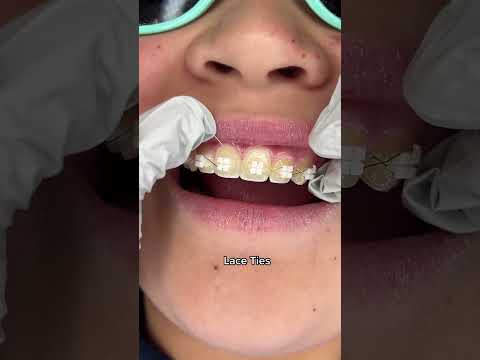 Different Types of Orthodontic Ties you can get at your Orthodontist Part 3