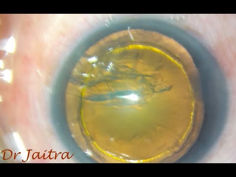 Phacoemulsification Cataract Surgery in Grade 2 Nuclear sclerosis by Dr Jaitra NS2#6