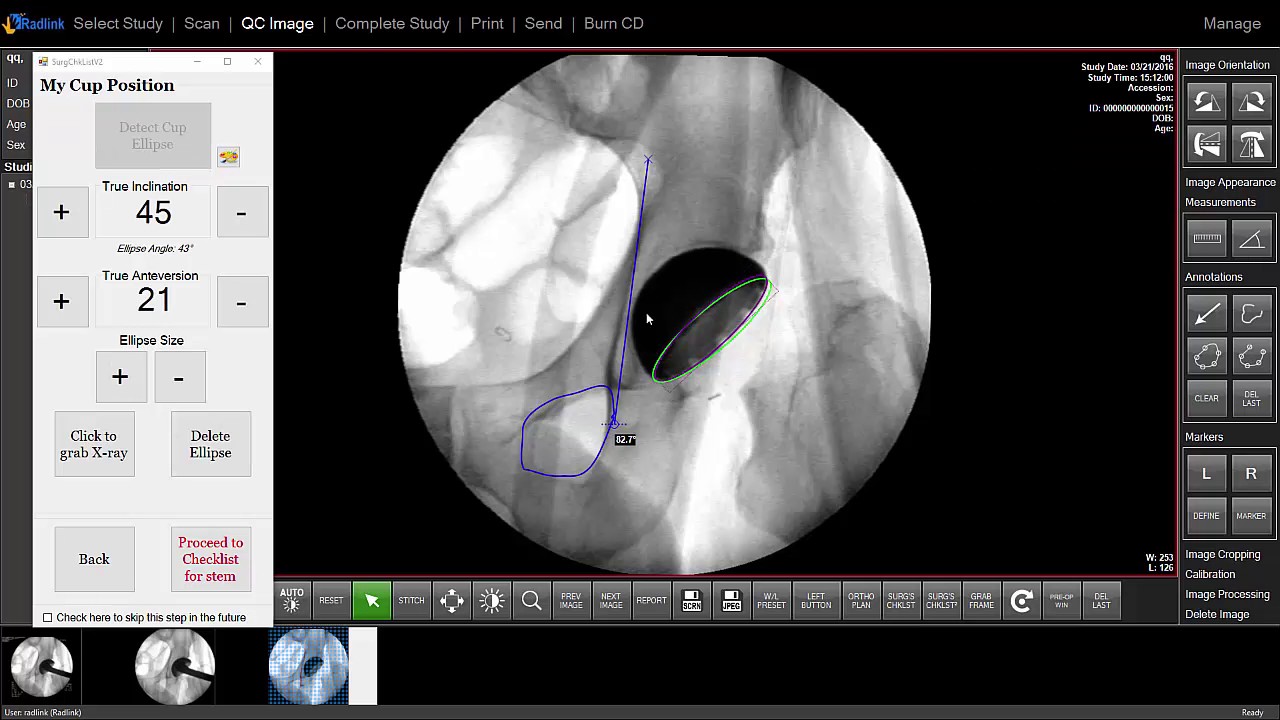 Radlink GPS Surgeon's Checklist Software Demo- Anterior Approach THA (Intra Op)