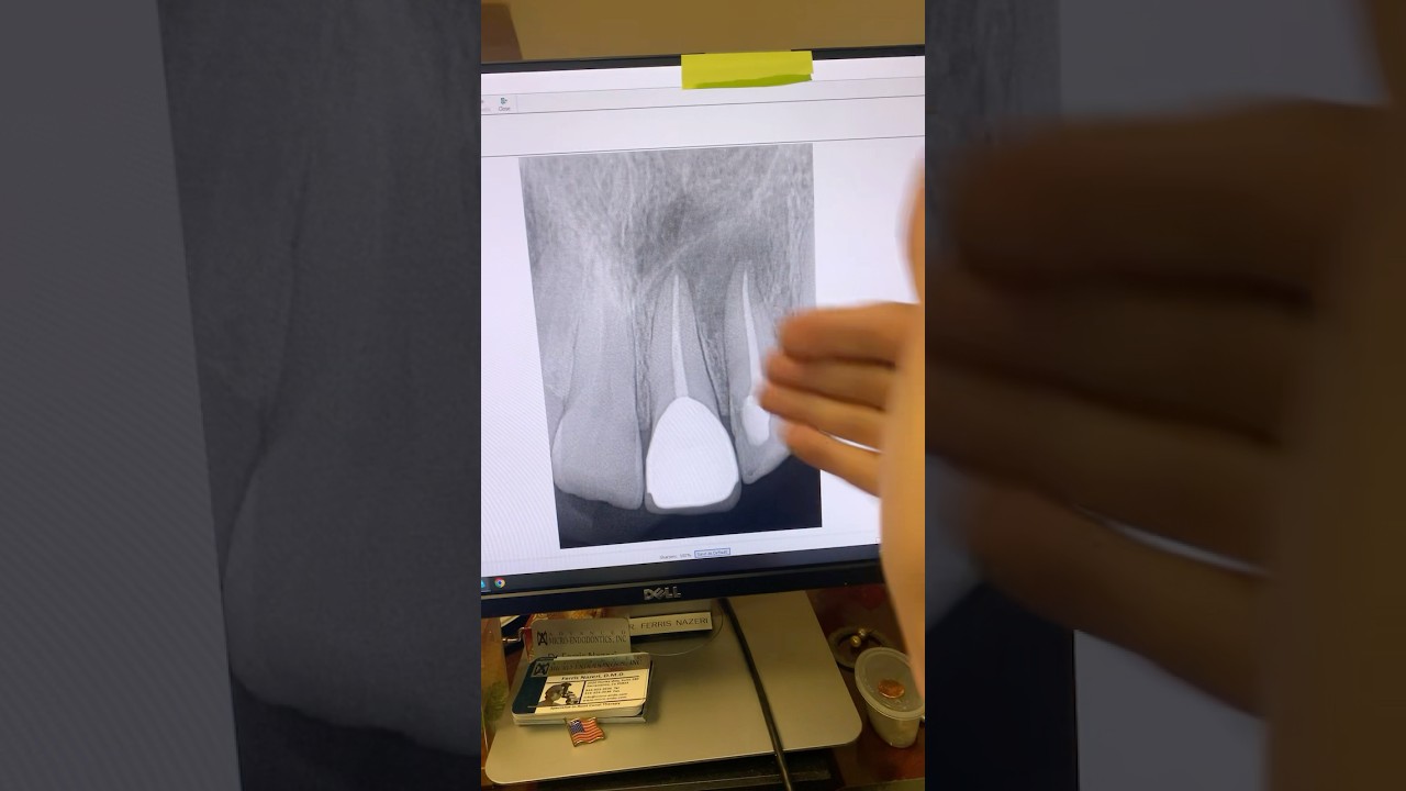 Why did these root canals fail? They look good! #endodontics #endodontist #rootcanal #dentist #teeth
