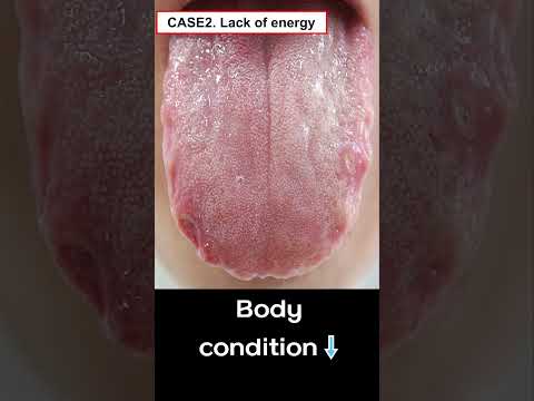 Scalloped Tongue : 3 Reasons for Tooth Marks #shorts