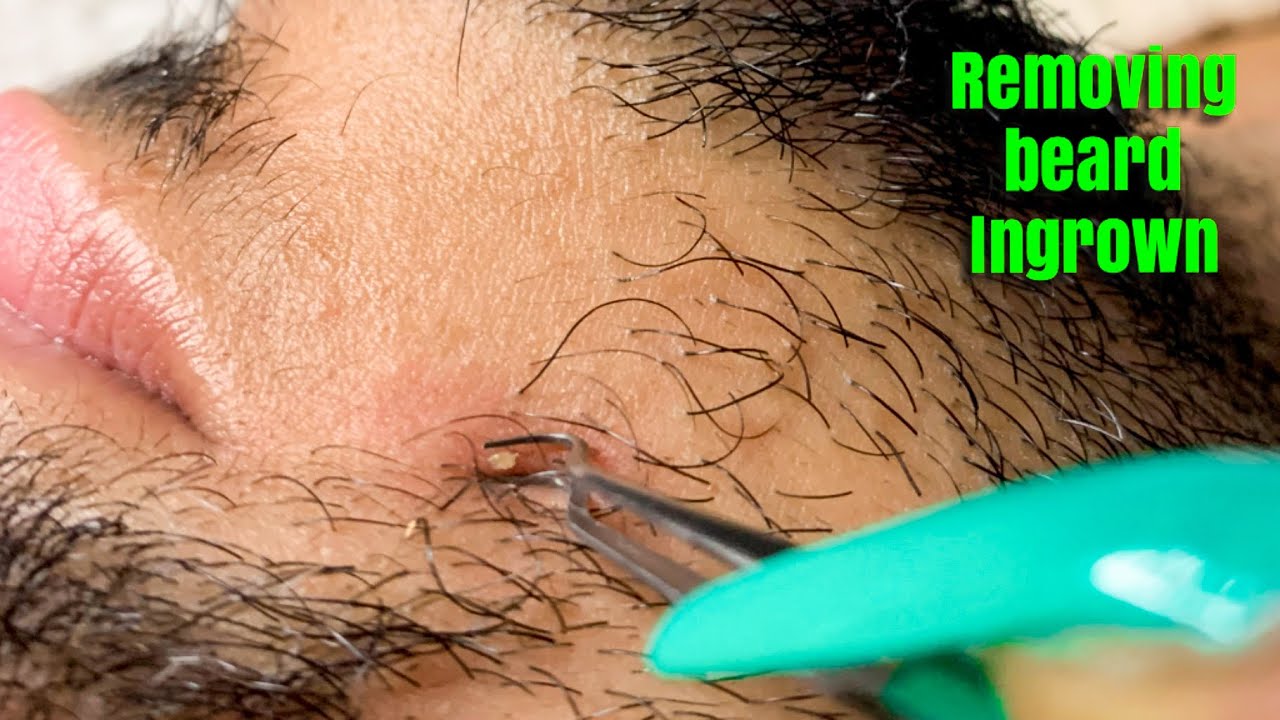 ASMR Upclose Zoom Removing ingrown hair from beard & moustache