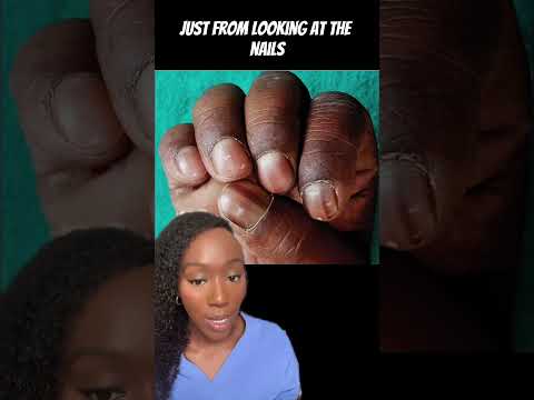 Could this be Cancer!? Melanonychia can be a benign or potentially serious condition #melanonychia