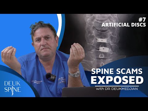 Artificial Disc Replacement Complications. (Ep.7 Spine Scams)