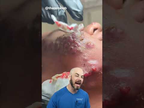 Reacting to SEVERE cystic acne (credit:@theacnelab on TT) #skincare #foryoupage #doctor #satisfying