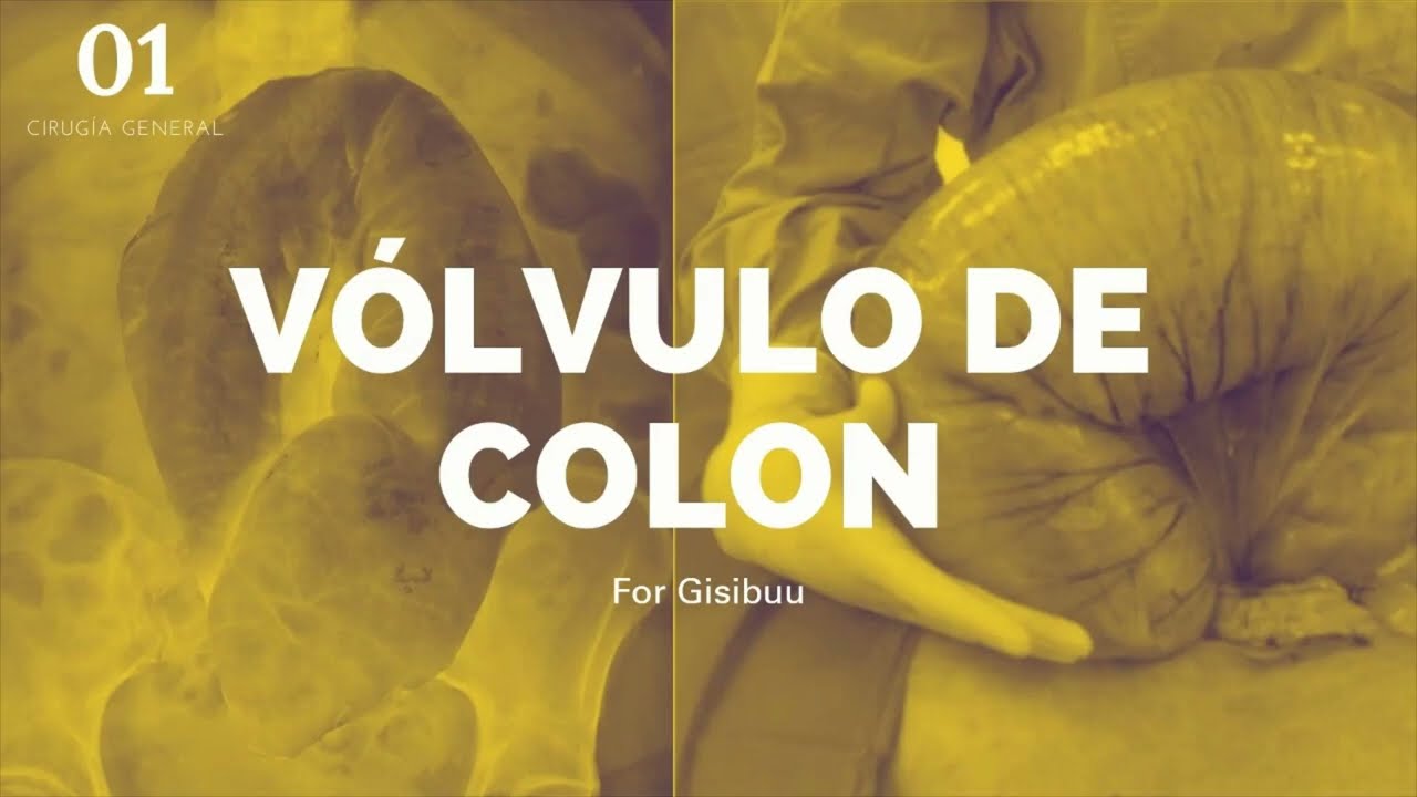 Vólvulo de colon - ENARM