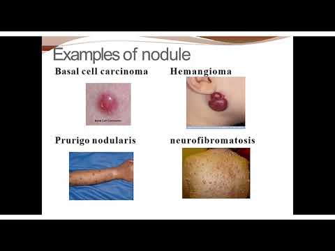 basic terminology used in skin lesion| macule |papule|pustules|nodule |vesicle |bullae