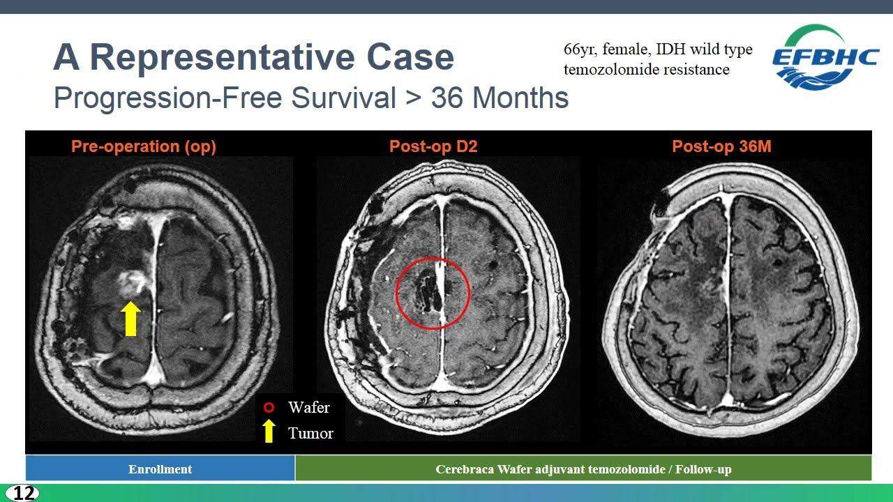 Everfront Biotech Holding Company Limited - Brain Cancer Clinical Programs and Research Pipelines