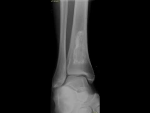 Bone Infarcts