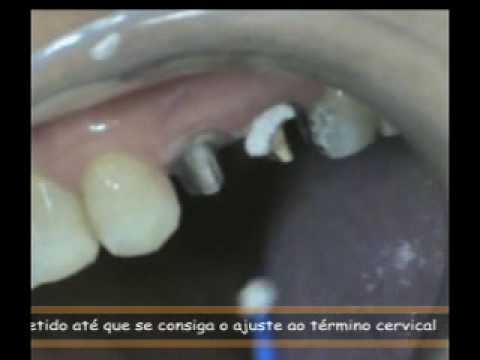 Como conferir a espessura do preparo protético???? « BLOG DenteSabio