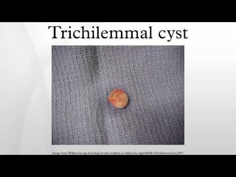 Trichilemmal cyst