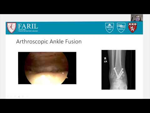 Ankle Arthroscopy Basics