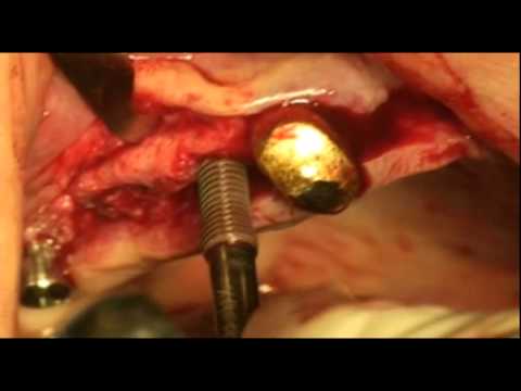 Help kit Dentium