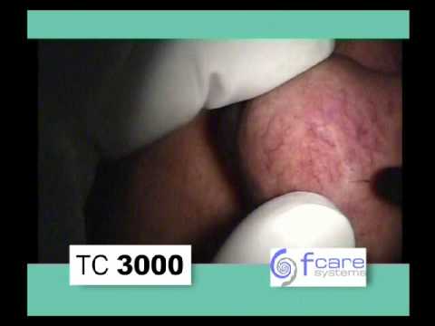 79 - Thread Veins Treatment Painless and Fast Removal for ThreadVeins
