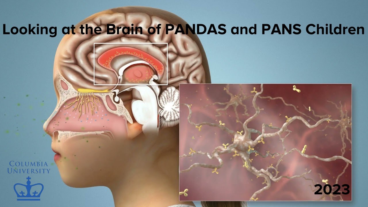Looking at the Brain of PANDAS and PANS Children