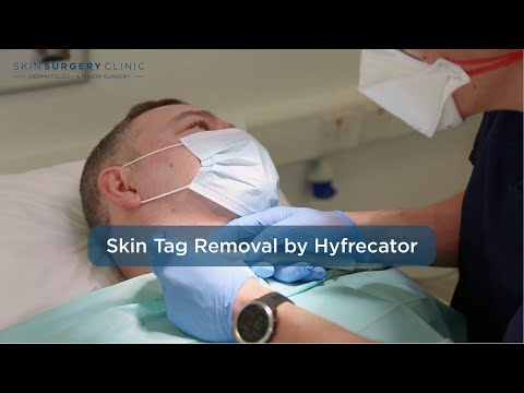 Skin Tag Removal with Dr Andrew Smith