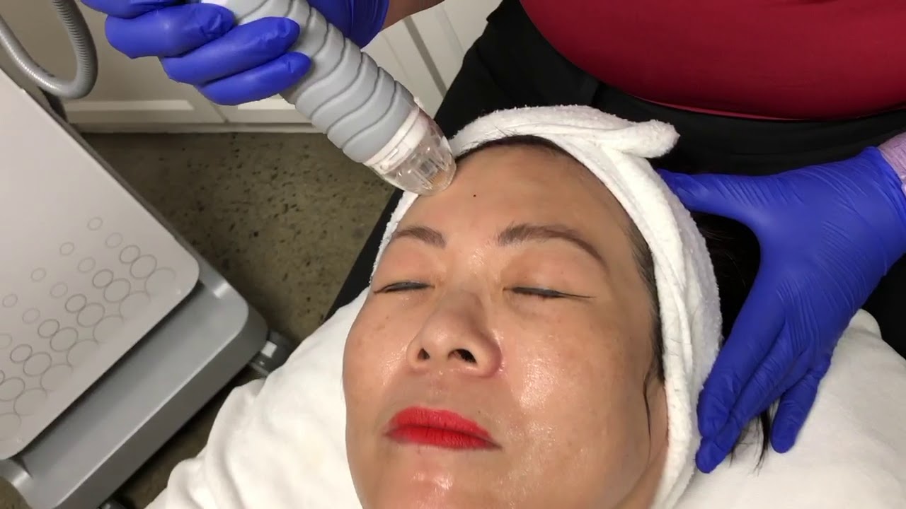 Vivace Skin Rejuvenation at Ultimate Aesthetics, Perth