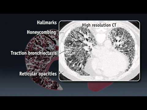 Animation - What is IPF?