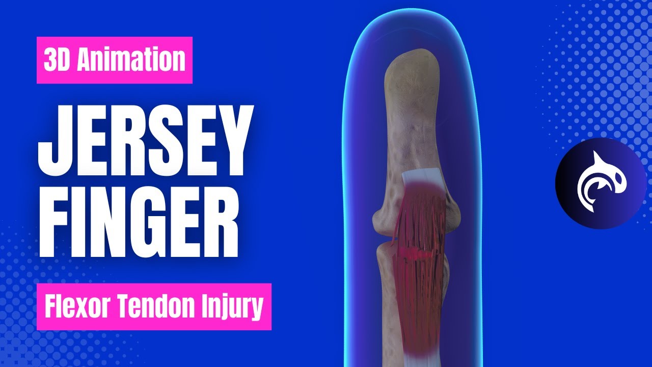 Jersey Finger (Flexor Tendon) Injury and Surgery - 3D animation
