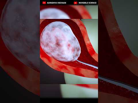 Understanding Abortion: 3D Animation Explaining D&E Procedures | Dilation and Evacuation