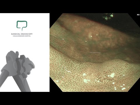 Image-Enhanced Endoscopy ( IEE ) for Colorectal lesions