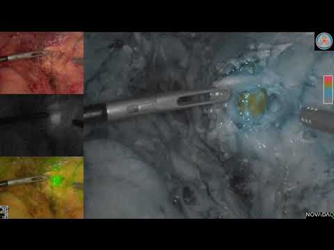 Laparoscopic Left Adrenalectomy with ICG